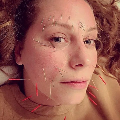 Facial Acupuncture in London | Cosmetic Acupuncturist
