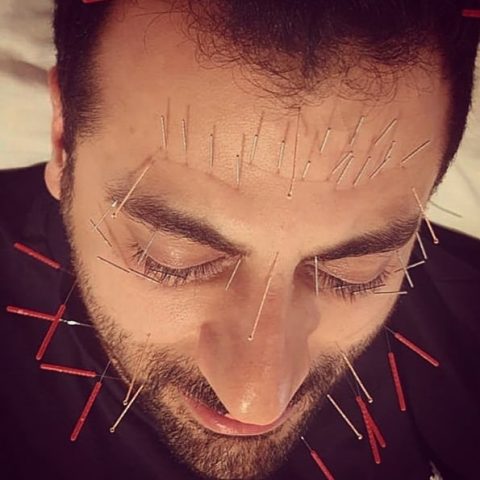 Facial Acupuncture in London | Cosmetic Acupuncturist